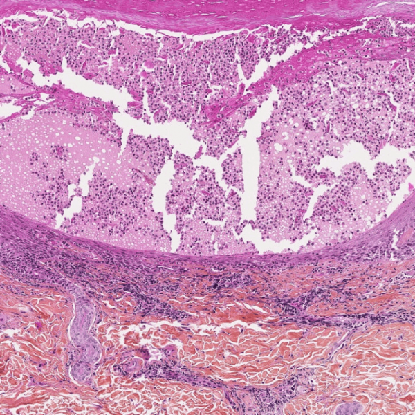 Psoriasis-pustuleux-generalisé-APHP_carre | Université Paris Cité
